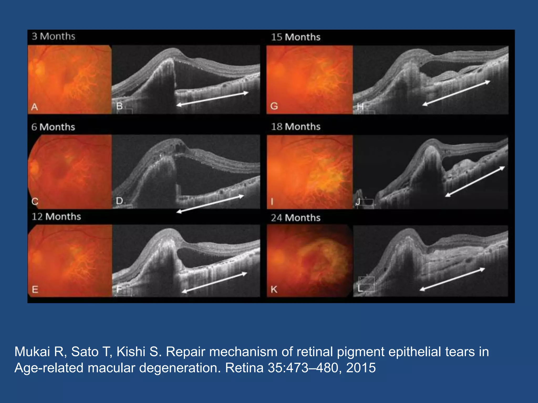RPE Tear,,,,Retinal Pigment Epithelium Tear.pptx