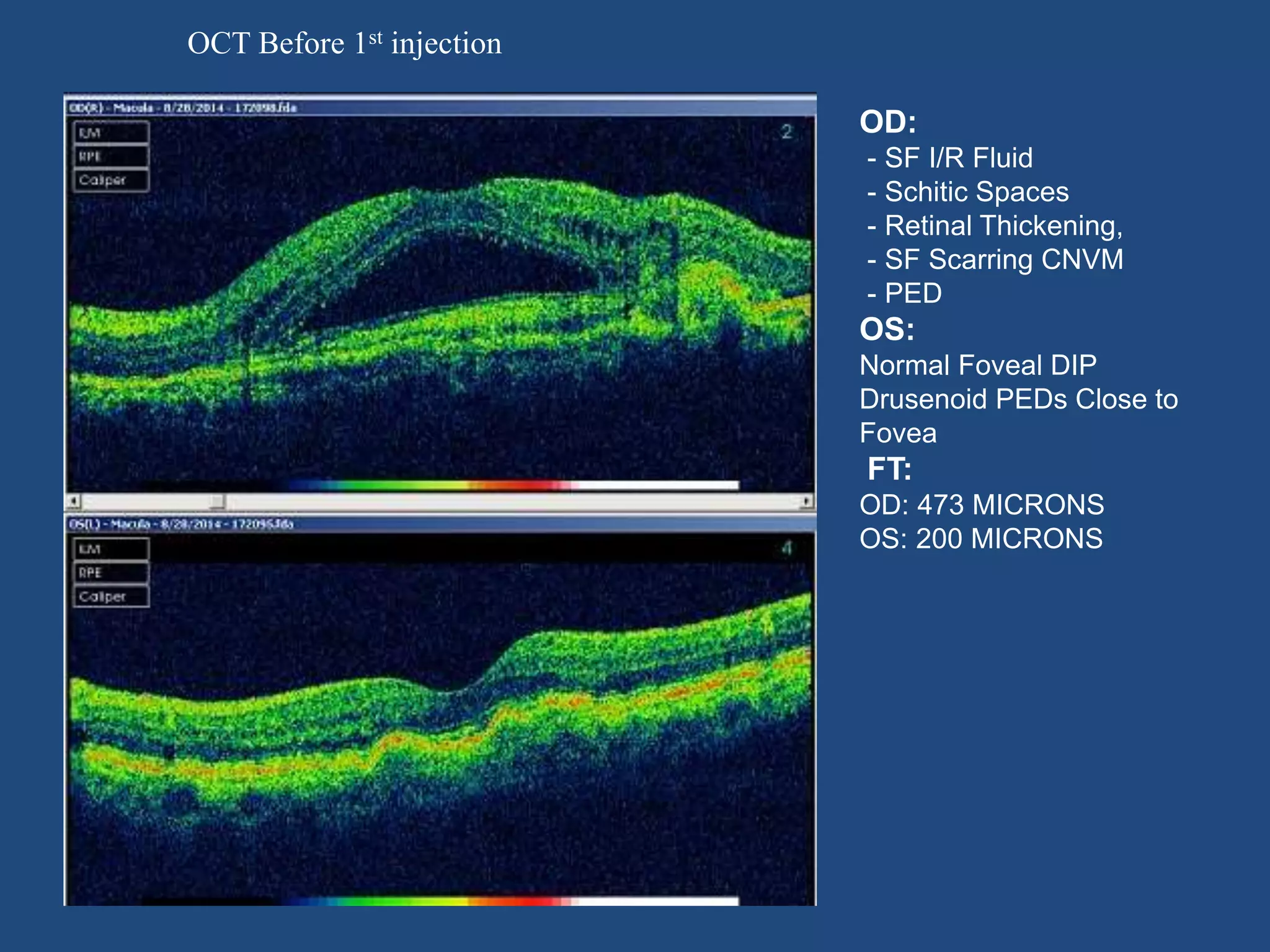 RPE Tear,,,,Retinal Pigment Epithelium Tear.pptx