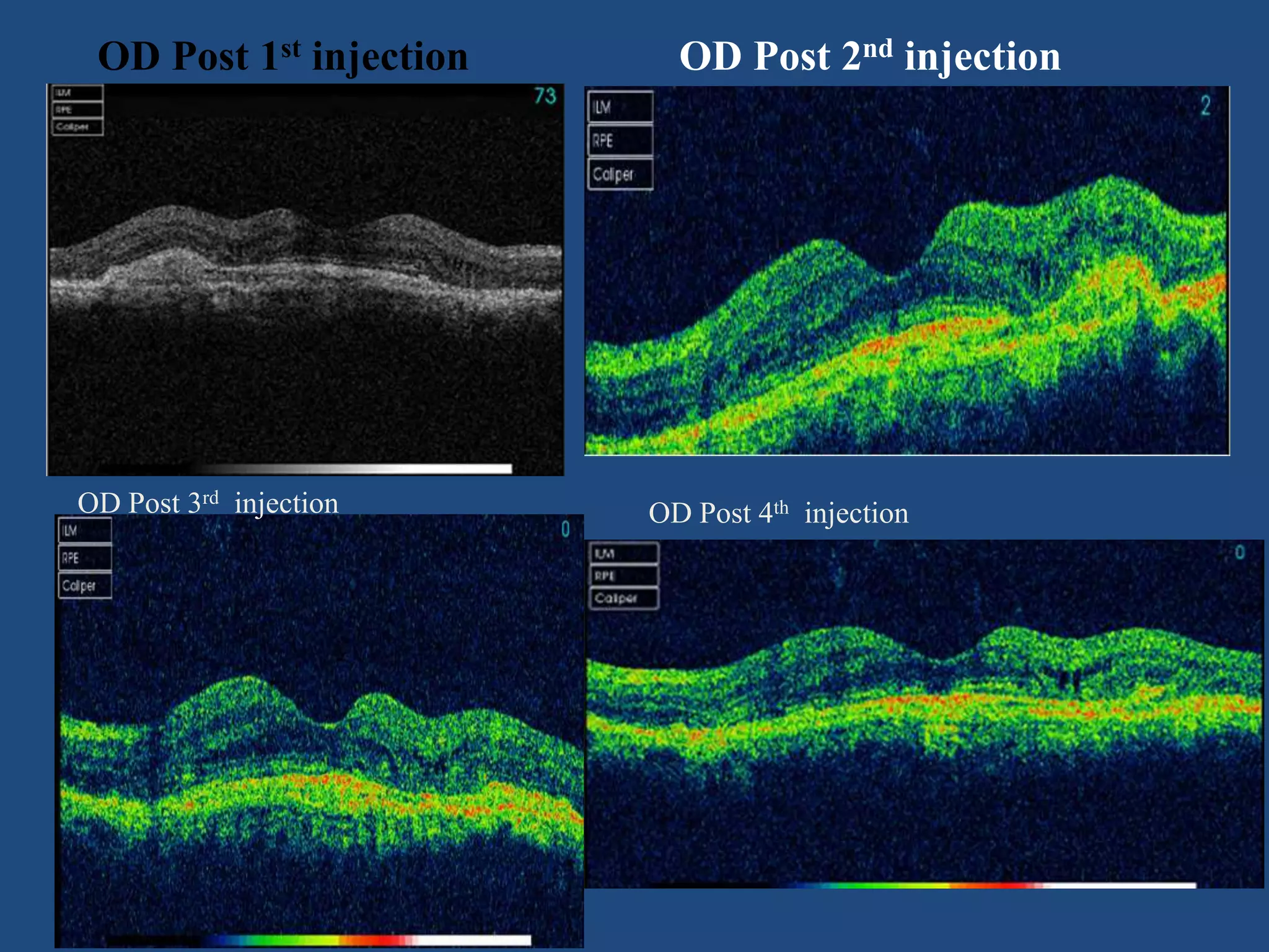 RPE Tear,,,,Retinal Pigment Epithelium Tear.pptx