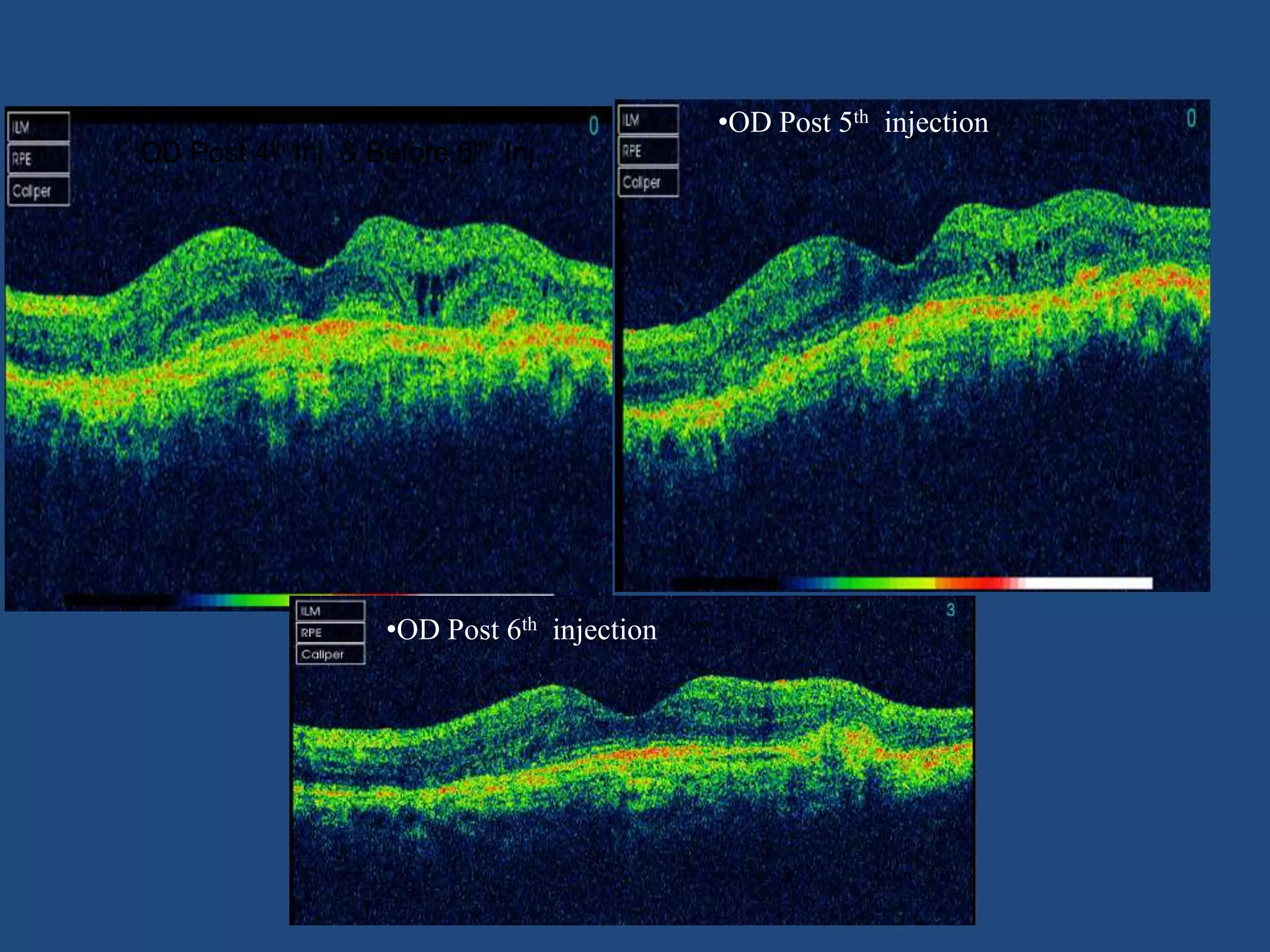RPE Tear,,,,Retinal Pigment Epithelium Tear.pptx