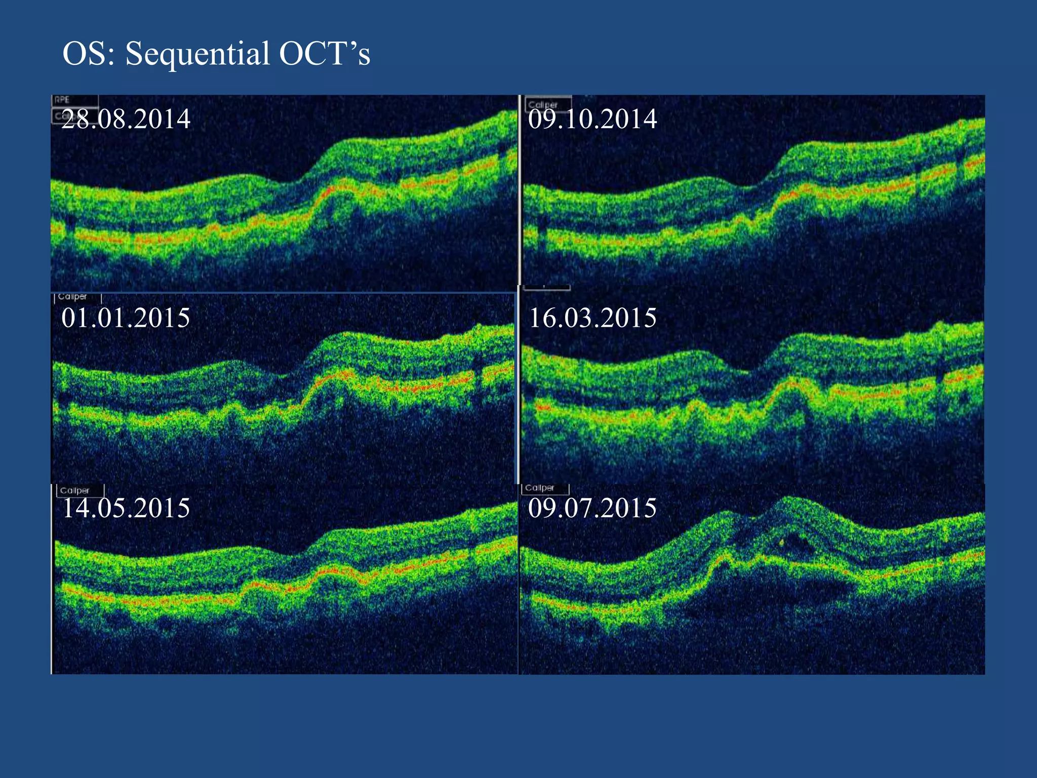 RPE Tear,,,,Retinal Pigment Epithelium Tear.pptx