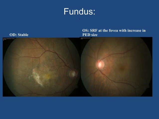 RPE Tear,,,,Retinal Pigment Epithelium Tear.pptx