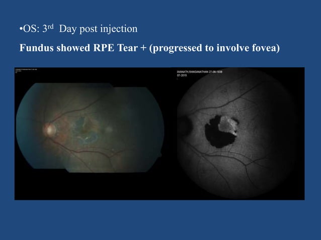 RPE Tear,,,,Retinal Pigment Epithelium Tear.pptx
