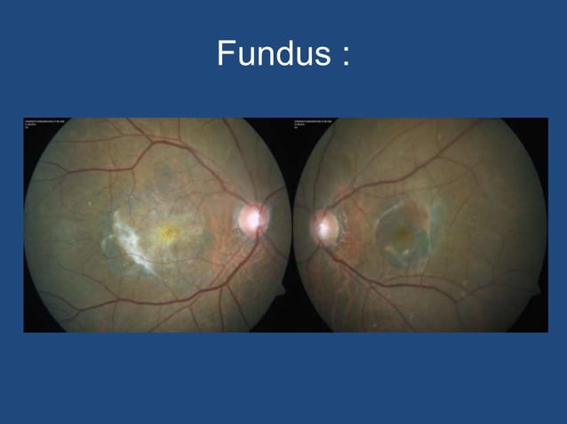 RPE Tear,,,,Retinal Pigment Epithelium Tear.pptx