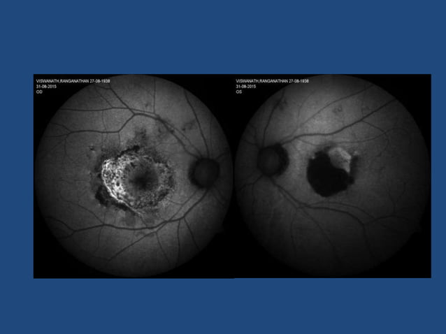 RPE Tear,,,,Retinal Pigment Epithelium Tear.pptx