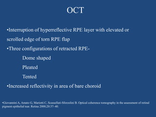 RPE Tear,,,,Retinal Pigment Epithelium Tear.pptx
