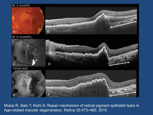 RPE Tear,,,,Retinal Pigment Epithelium Tear.pptx