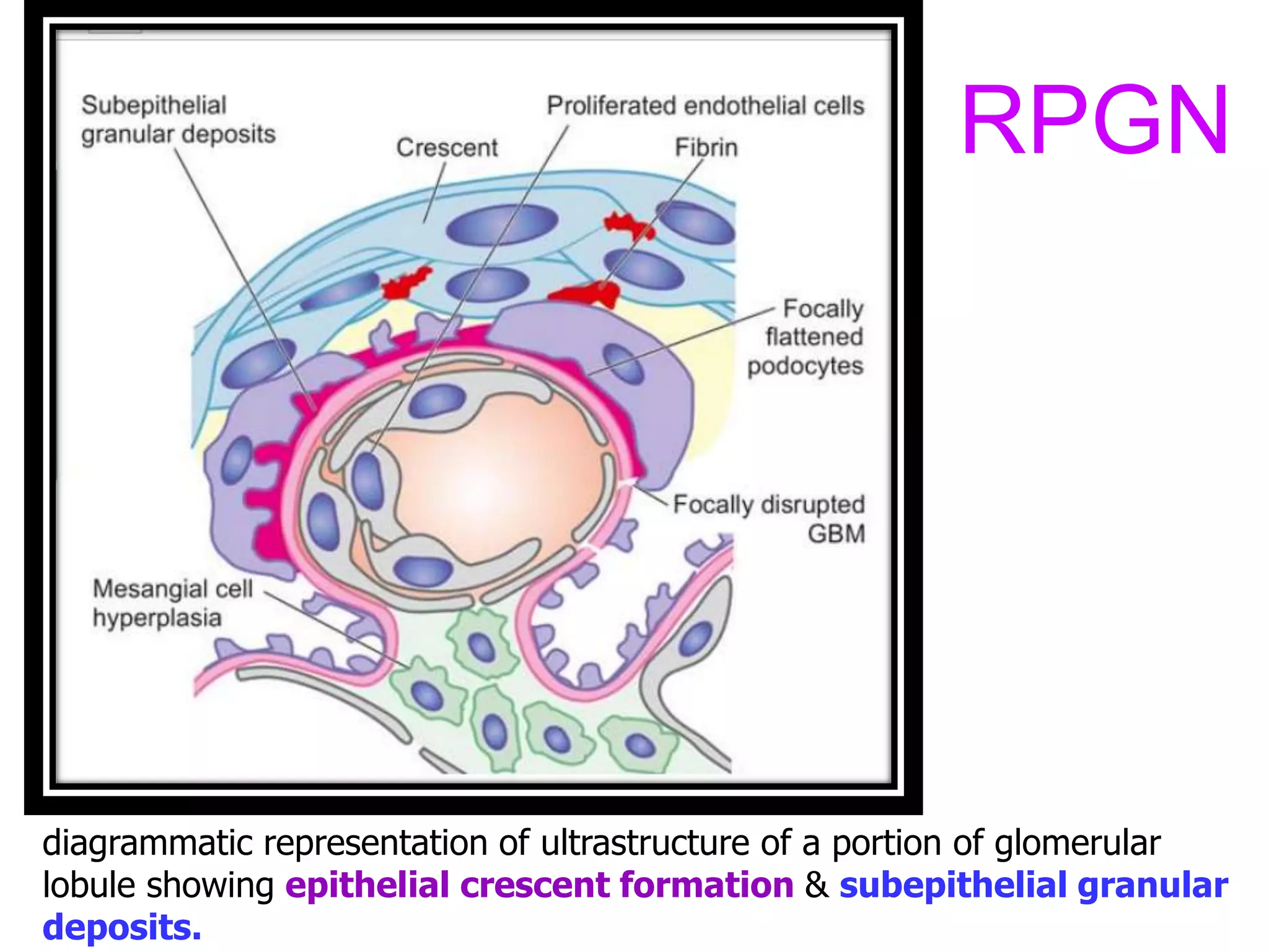 The KIDNEY: Rapidly Progressive Glomerulonephritis | PPTX
