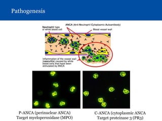 RPGN in Children.pptx