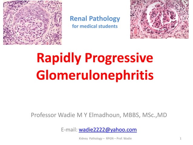 Rpgn renal pathology- prof wadie | PDF | Blood Disorders | Diseases and ...