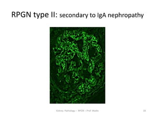 Rpgn renal pathology- prof wadie | PDF | Blood Disorders | Diseases and ...