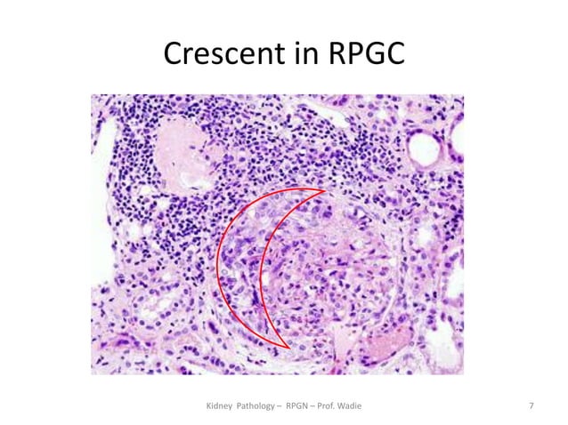 Rpgn renal pathology- prof wadie | PDF | Blood Disorders | Diseases and ...