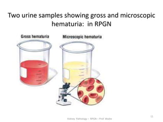 Rapidly Progressive Glomerulonephritis - renal pathology- prof wadie | PPTX