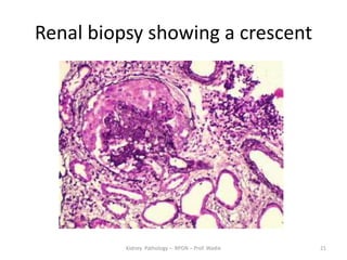 Rapidly Progressive Glomerulonephritis - renal pathology- prof wadie | PPTX