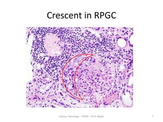 Rapidly Progressive Glomerulonephritis - renal pathology- prof wadie | PPT