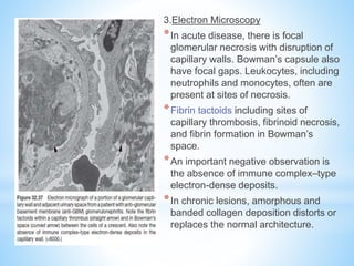 Rapidly Progressive Glomerulonephritis Em