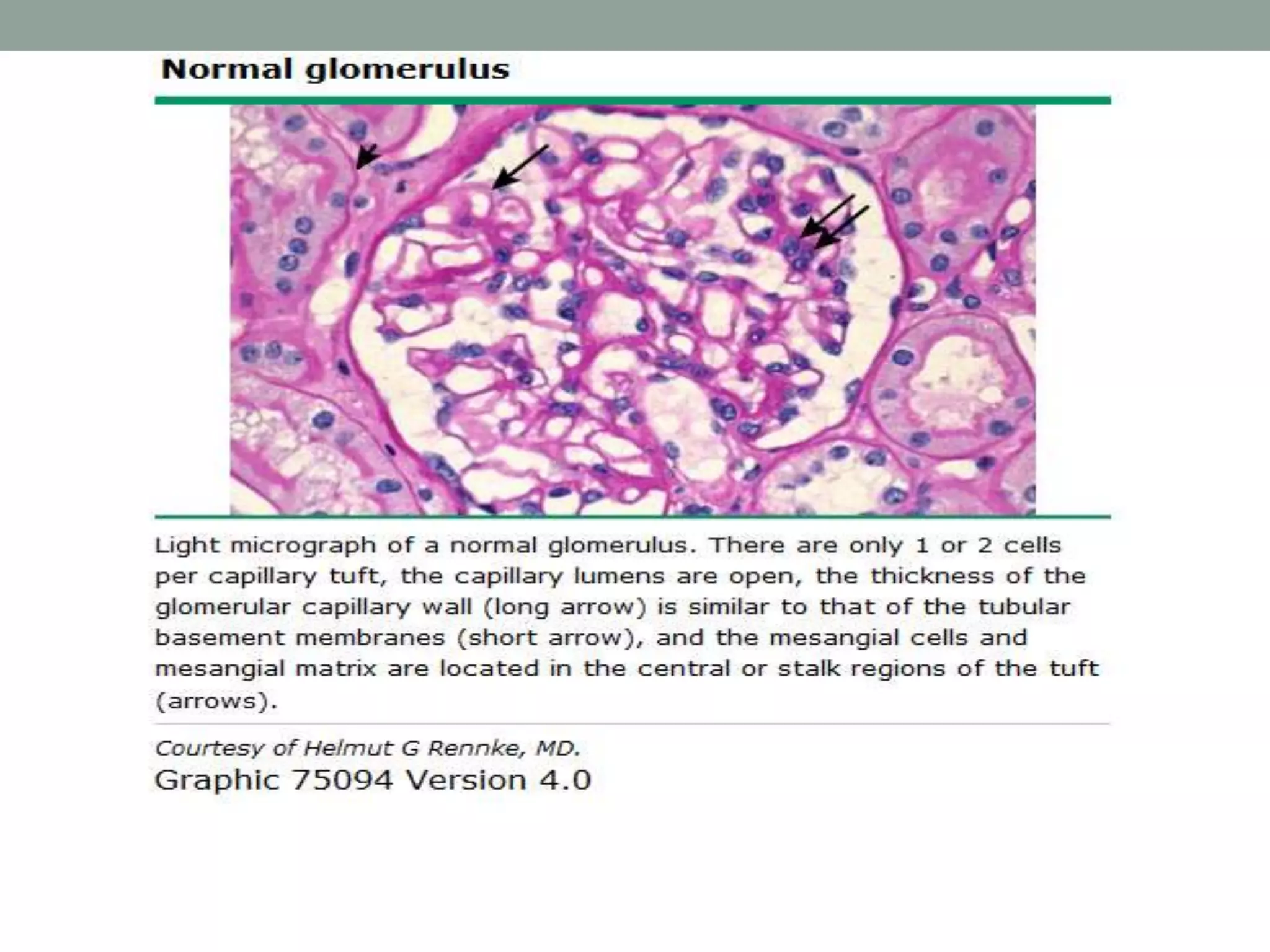 Rapidly progressive glomerulonephritis | PPTX | Blood Disorders | Diseases and Conditions