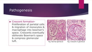 Rapidly progressive glomerulonephritis in children | PPTX