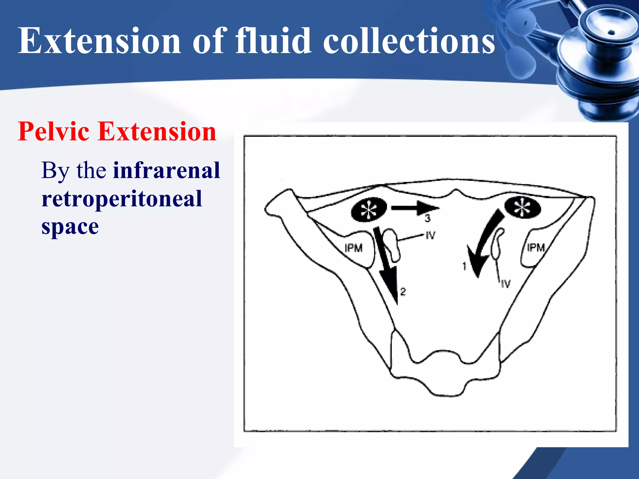 Retroperitoneal Collections | PPT