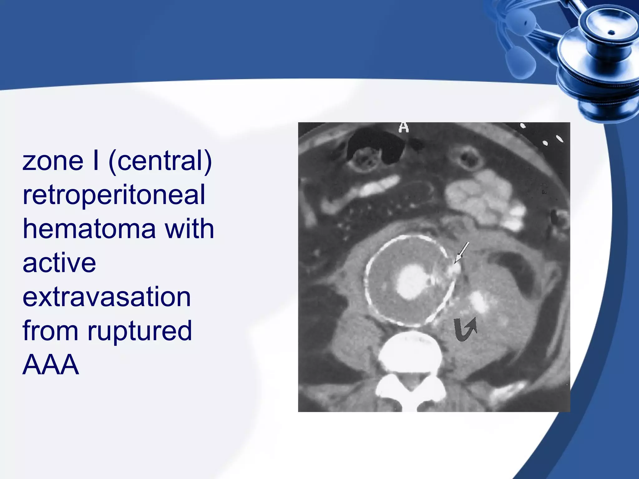 Retroperitoneal Collections | PPT