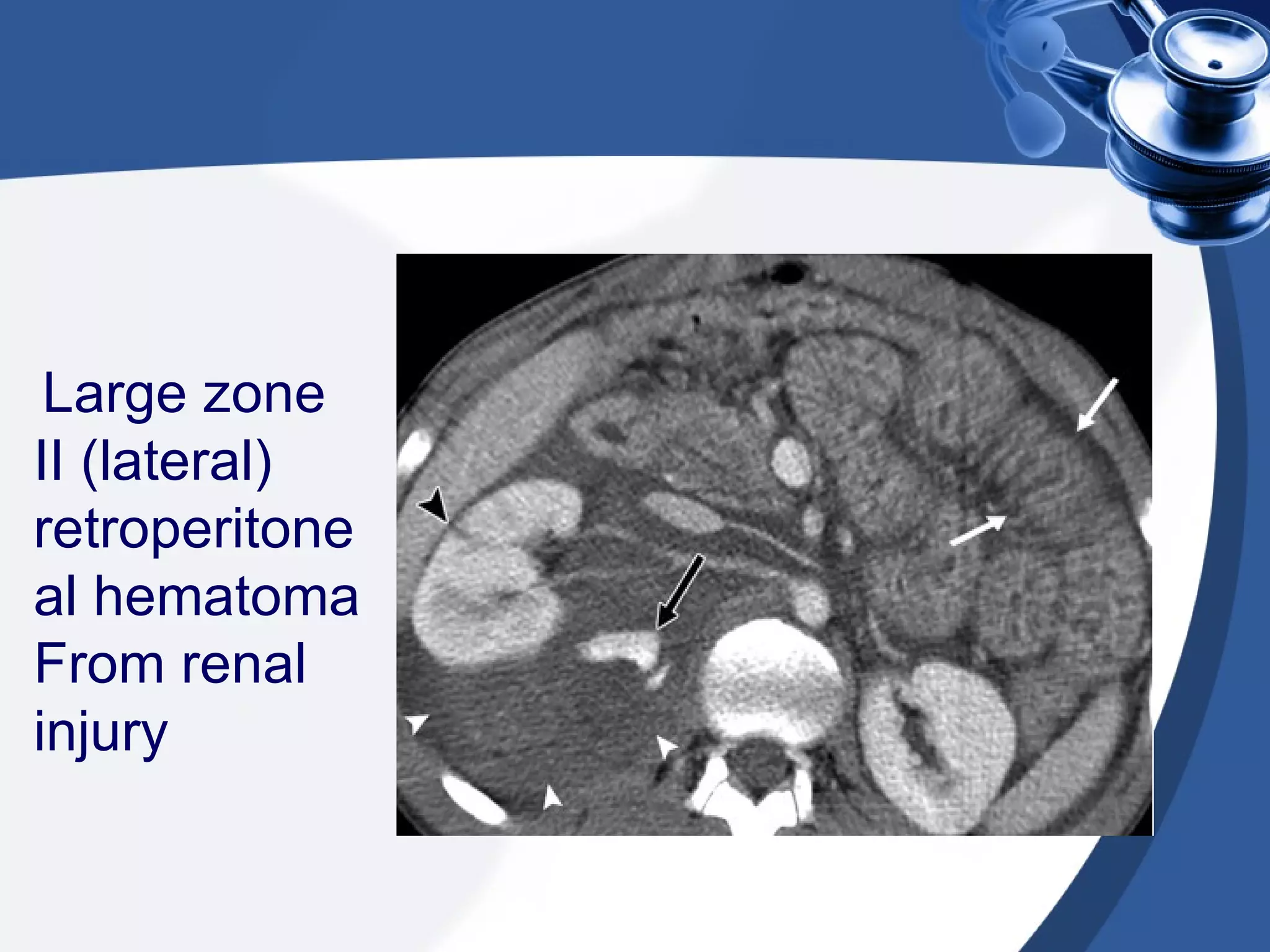 Retroperitoneal Collections | PPT