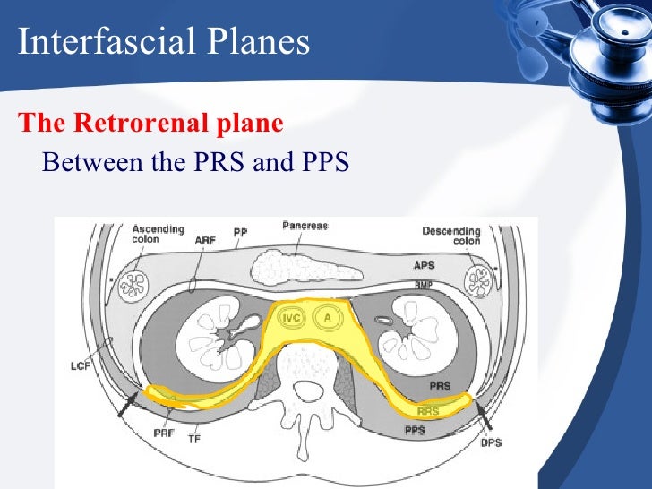 Retroperitoneal Collections