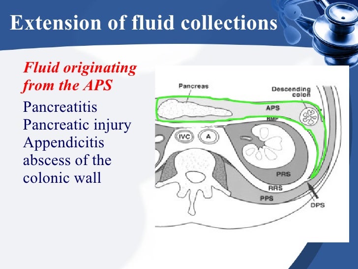 Retroperitoneal Collections