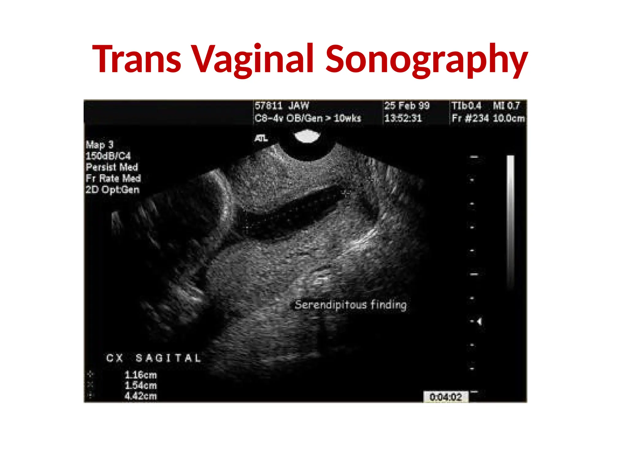 Recurrent pregnancy loss powerpoint presentation | PPT