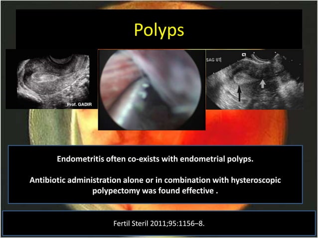 recurrent pregnancy loss | PPT