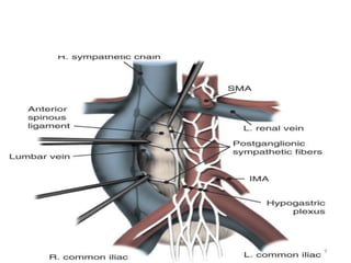 RETRO PERITONEAL LYMPHNODE DISSECTION CA | PPTX
