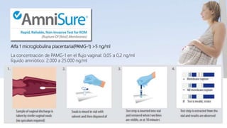 RUPTURA PREMATURA DE MEMBRANAS | PPTX