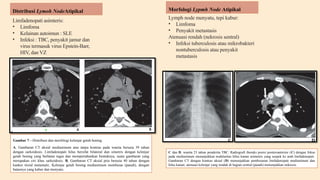 RP SARCOIDOSIS A DIAGNOSIS OF EXCLUSION.pptx