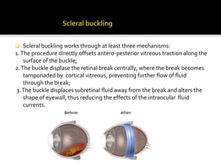 Rhegmatogenous Retinal Detachment --RRD | PPTX