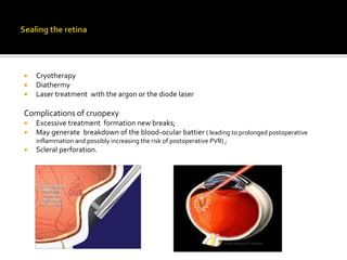 Rhegmatogenous Retinal Detachment --RRD | PPTX