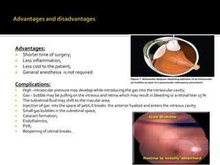 Rhegmatogenous Retinal Detachment --RRD | PPTX