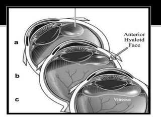 Rhegmatogenous Retinal Detachment --RRD | PPTX