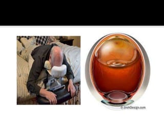 Rhegmatogenous Retinal Detachment --RRD | PPTX