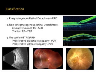 Rhegmatogenous Retinal Detachment --RRD | PPTX