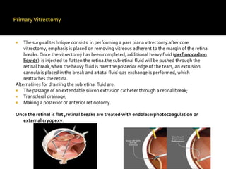 Rhegmatogenous Retinal Detachment --RRD | PPTX