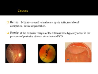 Rhegmatogenous Retinal Detachment --RRD | PPTX