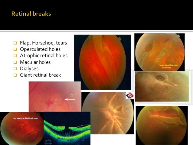 Operculated Tear