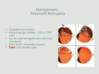 Rhegmetogenous Retinal Detachment- treatment and diagnosis.pptx