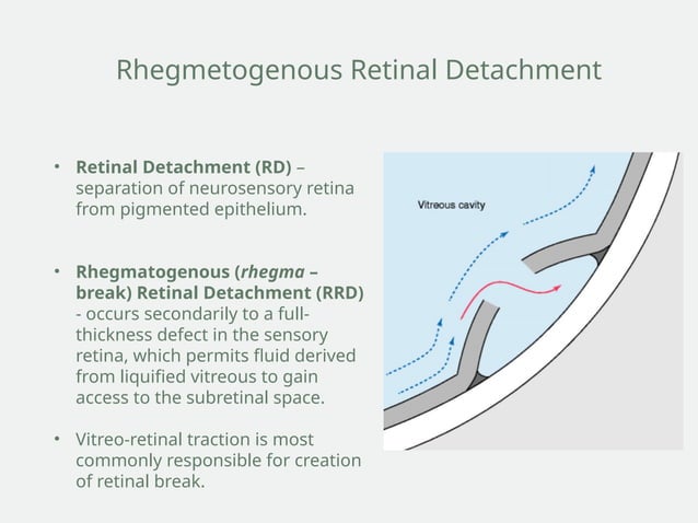 Rhegmetogenous Retinal Detachment- treatment and diagnosis.pptx