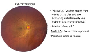 rhegmatogenous retinal detachment of the retina | PPTX