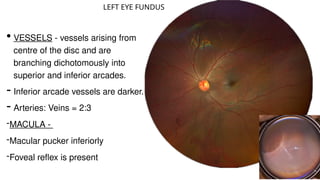 rhegmatogenous retinal detachment of the retina | PPTX