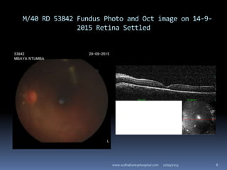 Rhegmatogenous Retinal Detachment with pvr management | PPT