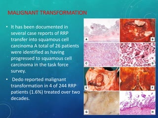recurrent respiratory papillomatosis | PDF