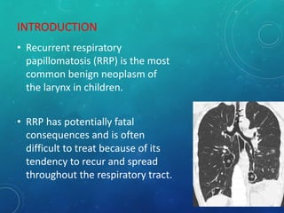 recurrent respiratory papillomatosis | PDF