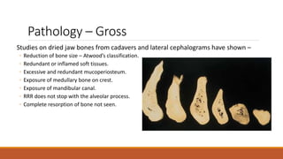 RESIDUAL RIDGE RESORPTION | PPTX