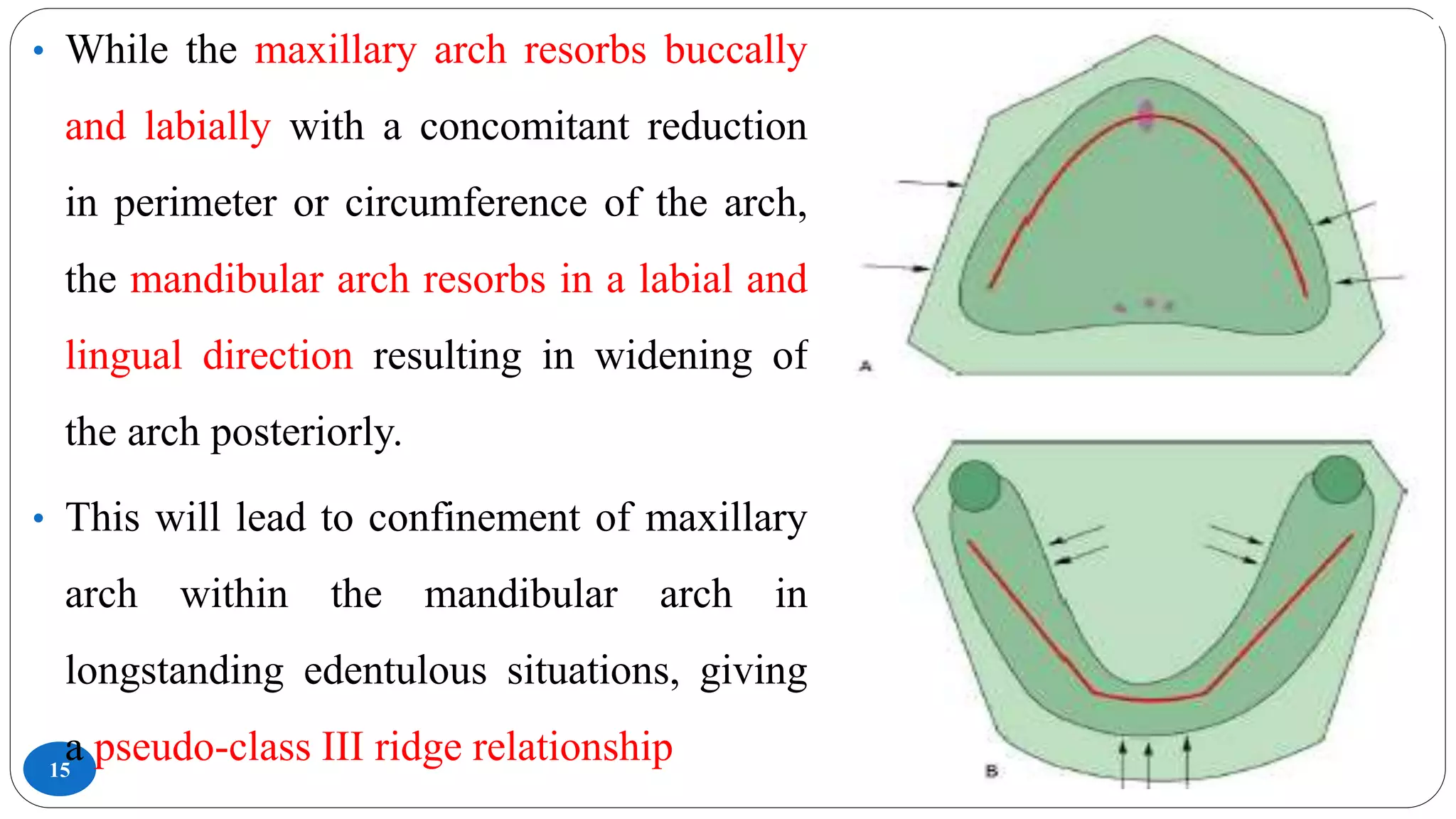 Resisual Ridge Resorption | PPTX